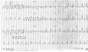 Identifying Electrocardiogram Errors And Artifacts | Executive ...