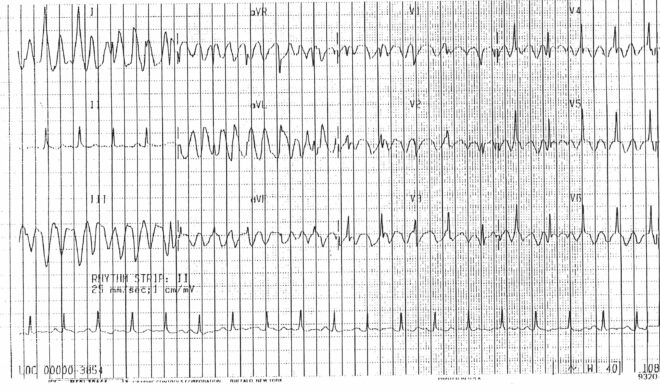 Identifying Electrocardiogram Errors And Artifacts | Executive ...