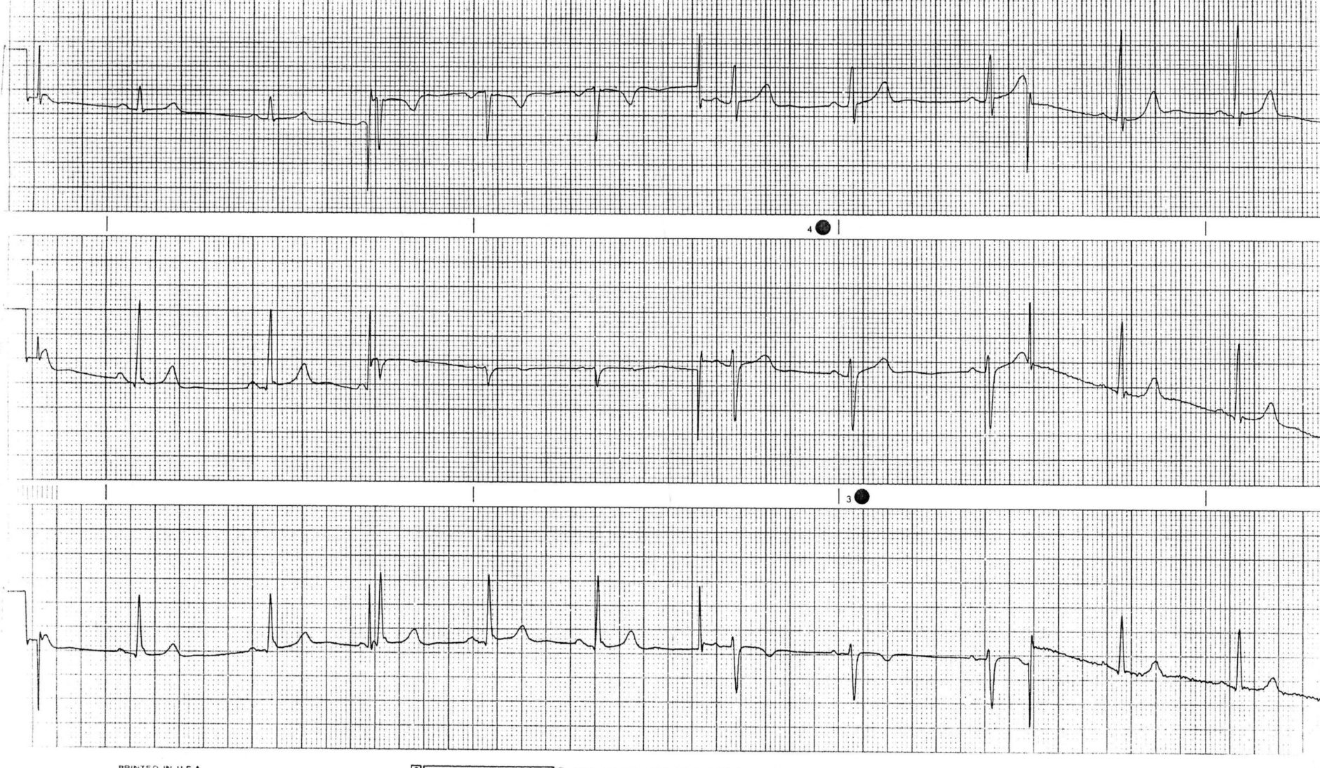 Identifying Electrocardiogram Errors And Artifacts - Executive ...