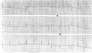 Identifying Electrocardiogram Errors And Artifacts - Executive ...