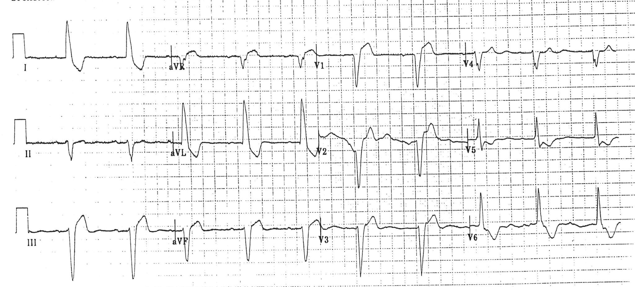 Electrocardiographic Changes That Mimic A Myocardial Infarction-ECGedu
