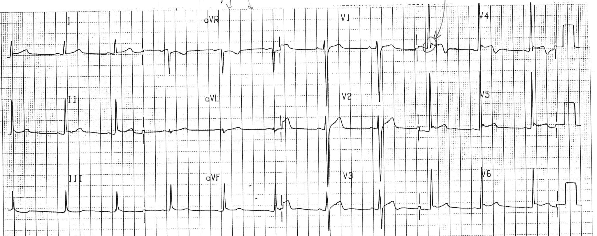 Electrocardiographic Changes That Mimic A Myocardial Infarction-ECGedu