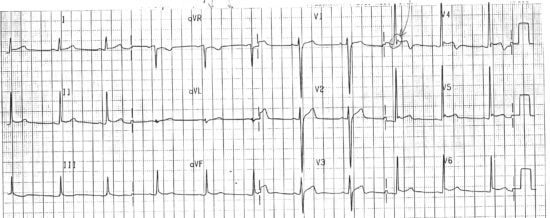 Electrocardiographic Changes That Mimic A Myocardial Infarction-ECGedu