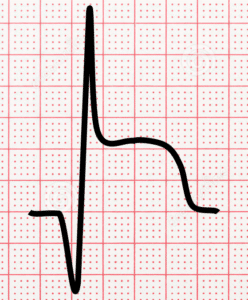 How To Recognize And Diagnose Heart Attacks | ECGEDU