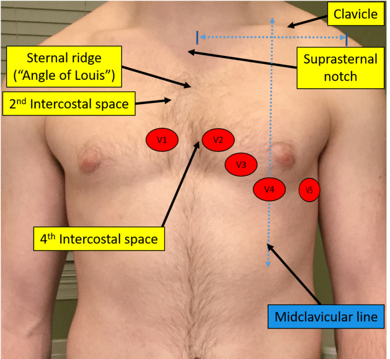 Proper Electrocardiogram ECG EKG Lead Placement ECGEDU Proper Electrocardiogram ECG EKG Lead Placement ECGEDU
