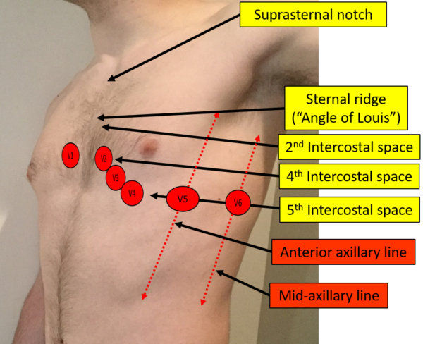 Proper Electrocardiogram (ECG/EKG) Lead Placement | ECGEDU Proper Electrocardiogram (ECG/EKG) Lead Placement | ECGEDU