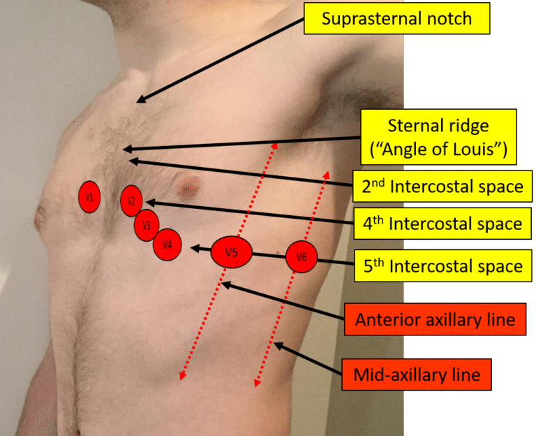Proper Electrocardiogram (ECG/EKG) Lead Placement | ECGEDU
