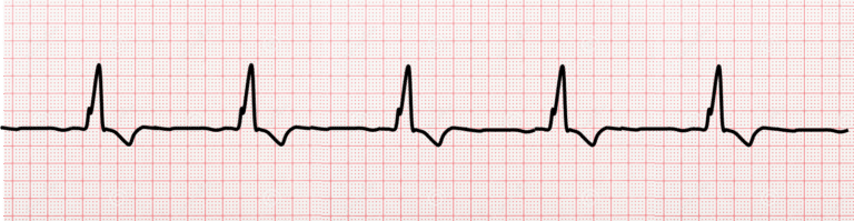 What To Expect From A Good Holter Monitor Reading