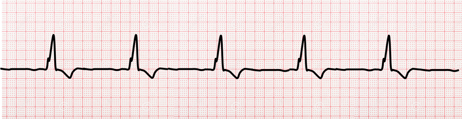 What To Expect From A Good Holter Monitor Reading