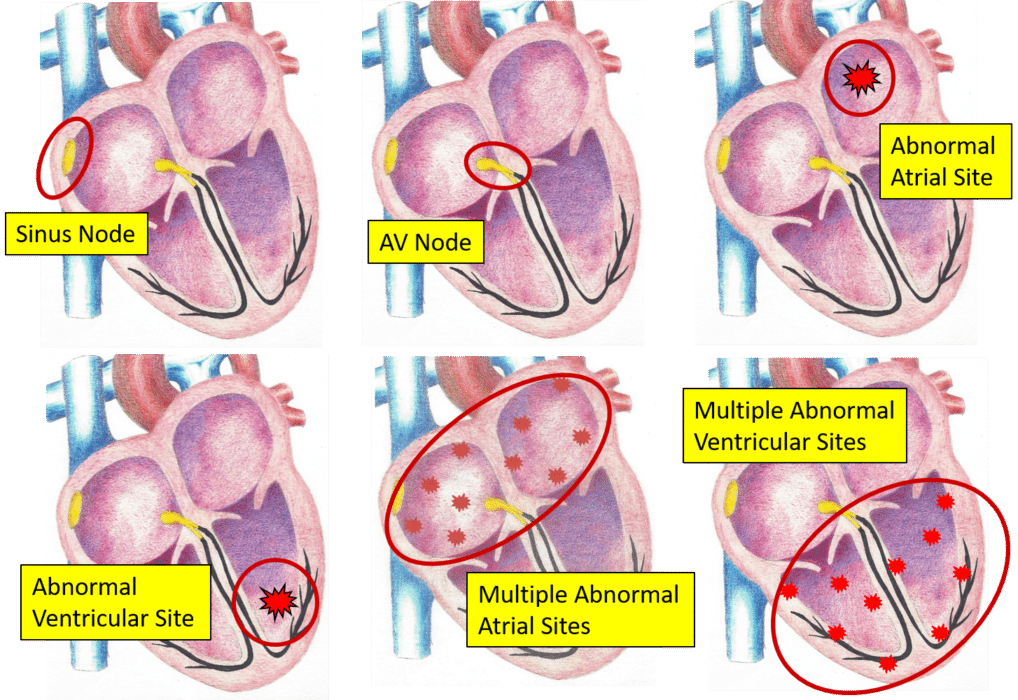 ACLS Rhythms Learn Terminology, Definitions, Pathophysiology