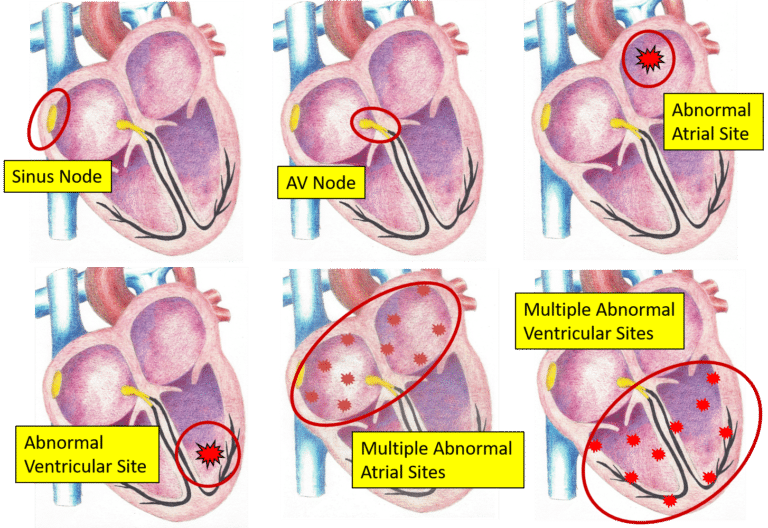 ACLS Rhythms Learn Terminology, Definitions, Pathophysiology