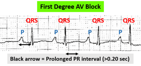 Differentiating Atrioventricular (AV) Blocks | ECGEDU.com