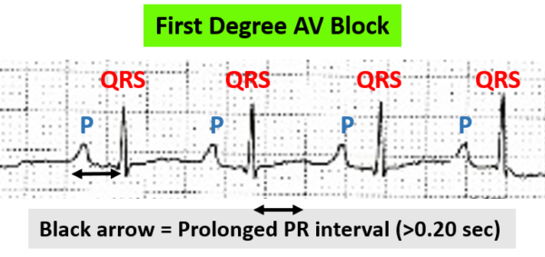 Differentiating Atrioventricular (AV) Blocks | ECGEDU.com