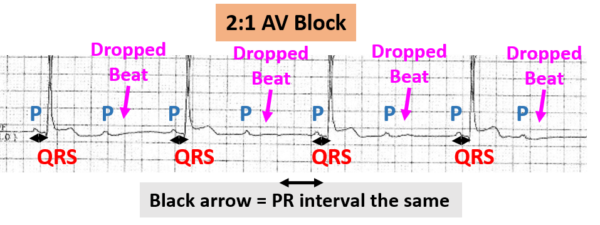 Differentiating Atrioventricular (AV) Blocks | ECGEDU.com