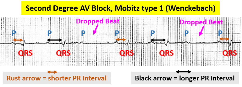 Differentiating Atrioventricular (AV) Blocks | ECGEDU.com
