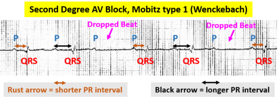 Differentiating Atrioventricular (AV) Blocks | ECGEDU.com