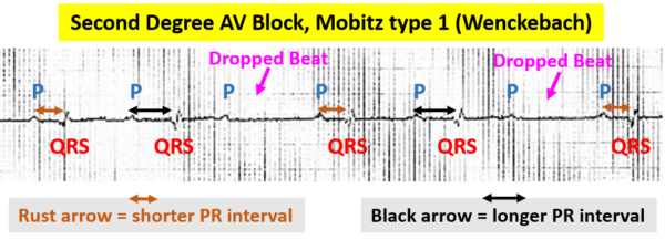 Differentiating Atrioventricular (AV) Blocks | ECGEDU.com