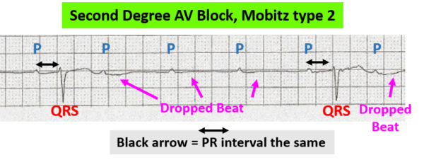 Differentiating Atrioventricular (AV) Blocks | ECGEDU.com