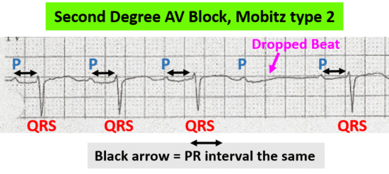 Differentiating Atrioventricular (AV) Blocks | ECGEDU.com