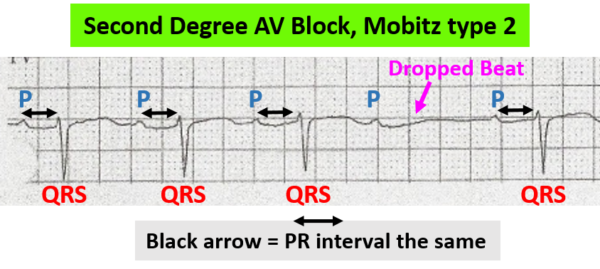 Differentiating Atrioventricular (AV) Blocks | ECGEDU.com