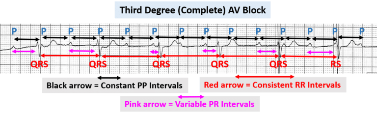 Differentiating Atrioventricular (AV) Blocks | ECGEDU.com