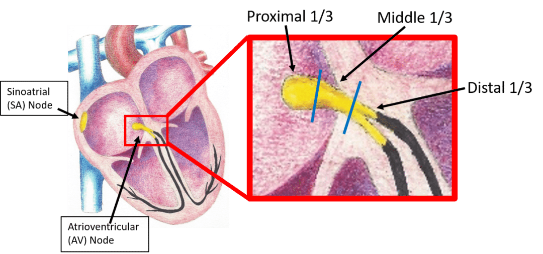 Differentiating Atrioventricular (AV) Blocks | ECGEDU.com