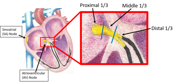 Differentiating Atrioventricular (AV) Blocks | ECGEDU.com