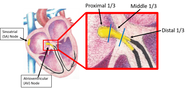 Differentiating Atrioventricular (AV) Blocks | ECGEDU.com