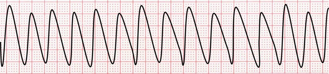 Ventricular Tachycardia vs. Ventricular Fibrillation On An ECG