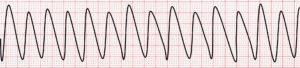 Ventricular Tachycardia vs. Ventricular Fibrillation On An ECG