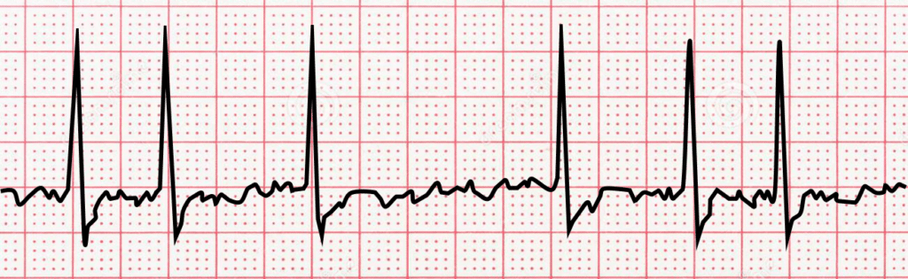 ECG Interpretation Examples - Typical Patterns You Should Know (PDF ...
