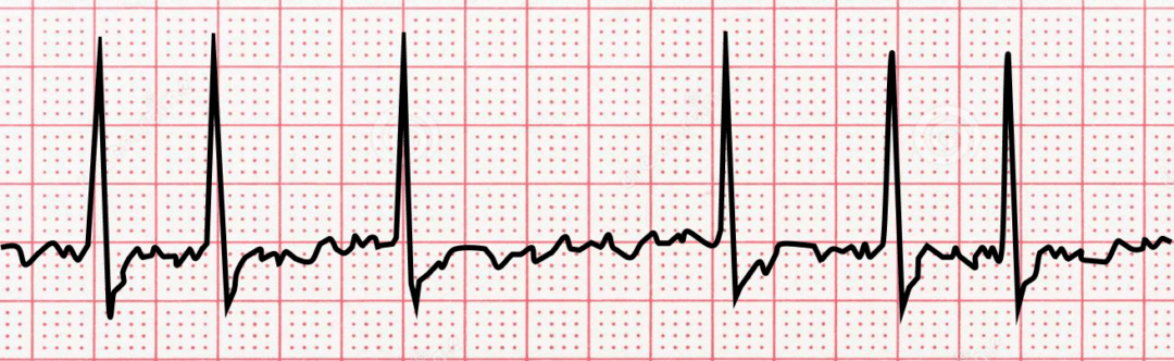 ECG Interpretation Examples - Typical Patterns You Should Know (PDF ...