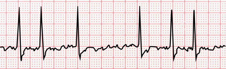 ECG Interpretation Examples - Typical Patterns You Should Know (PDF ...