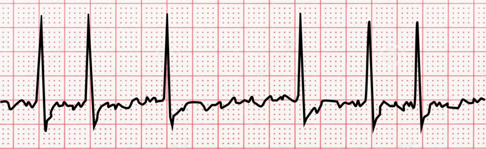 ECG Interpretation Examples - Typical Patterns You Should Know (PDF ...