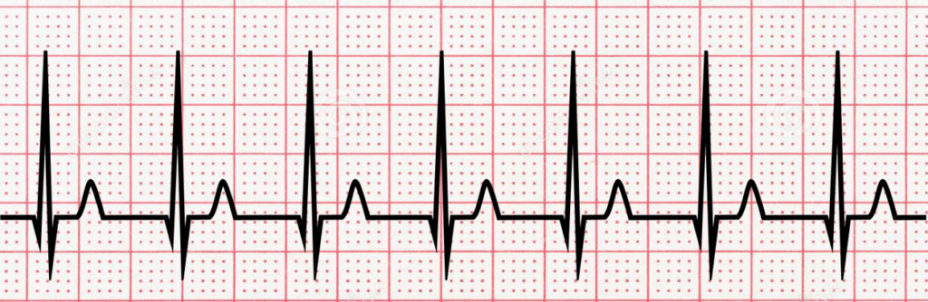 ECG Interpretation Examples - Typical Patterns You Should Know (PDF ...