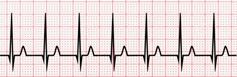 ECG Interpretation Examples - Typical Patterns You Should Know (PDF ...