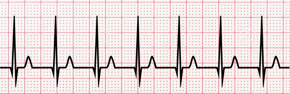 ECG Interpretation Examples - Typical Patterns You Should Know (PDF ...