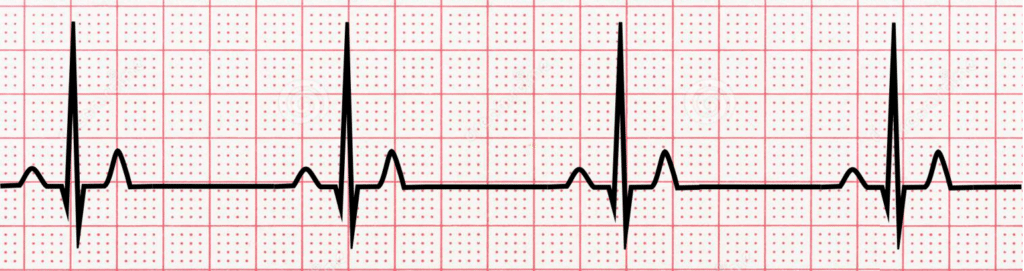 ECG Interpretation Examples - Typical Patterns You Should Know (PDF ...
