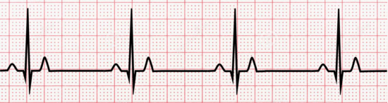 ECG Interpretation Examples - Typical Patterns You Should Know (PDF ...