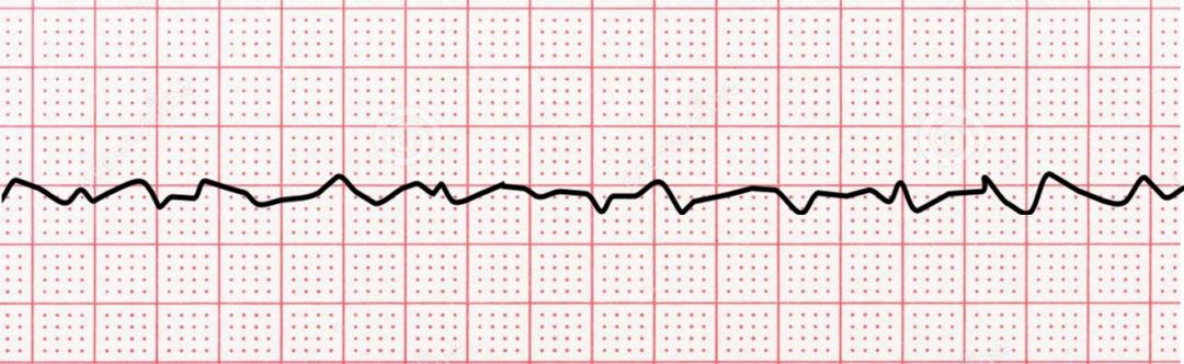 ECG Interpretation Examples - Typical Patterns You Should Know (PDF ...