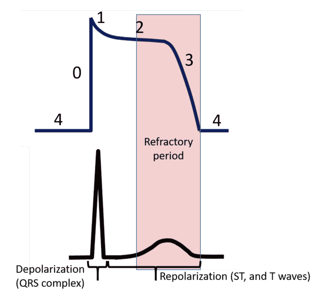 R on T Premature Ventricular Complexes (PVC) Simplified | ECGEDU.com