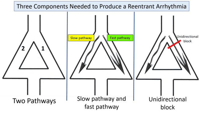 R on T Premature Ventricular Complexes (PVC) Simplified | ECGEDU.com