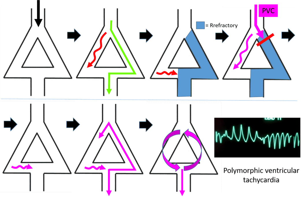 R on T Premature Ventricular Complexes (PVC) Simplified | ECGEDU.com