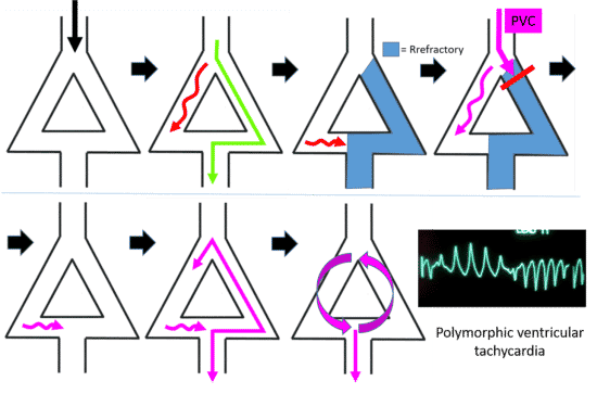 R on T Premature Ventricular Complexes (PVC) Simplified | ECGEDU.com