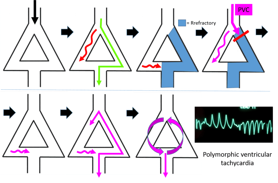 R on T Premature Ventricular Complexes (PVC) Simplified | ECGEDU.com