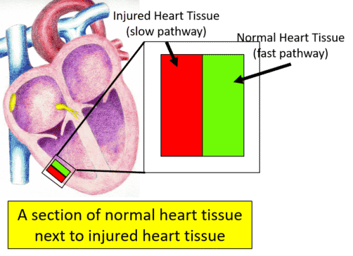 R on T Premature Ventricular Complexes (PVC) Simplified | ECGEDU.com