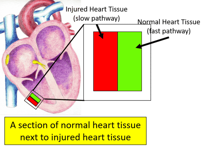 R on T Premature Ventricular Complexes (PVC) Simplified | ECGEDU.com