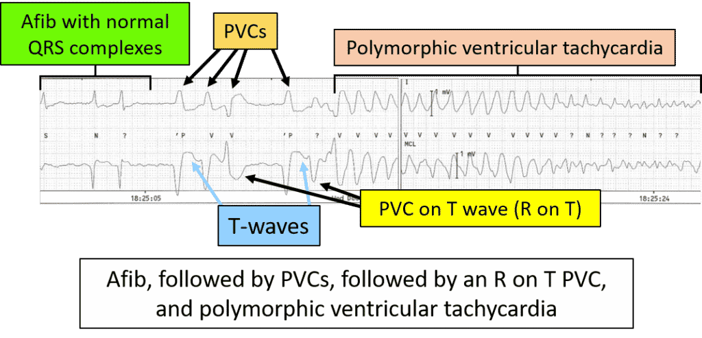 R on T Premature Ventricular Complexes (PVC) Simplified | ECGEDU.com