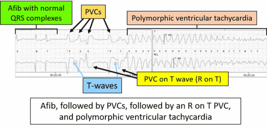 R on T Premature Ventricular Complexes (PVC) Simplified | ECGEDU.com