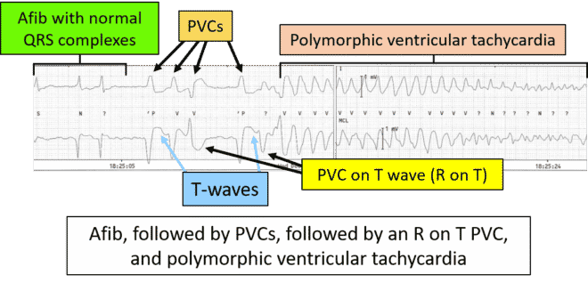 R on T Premature Ventricular Complexes (PVC) Simplified | ECGEDU.com